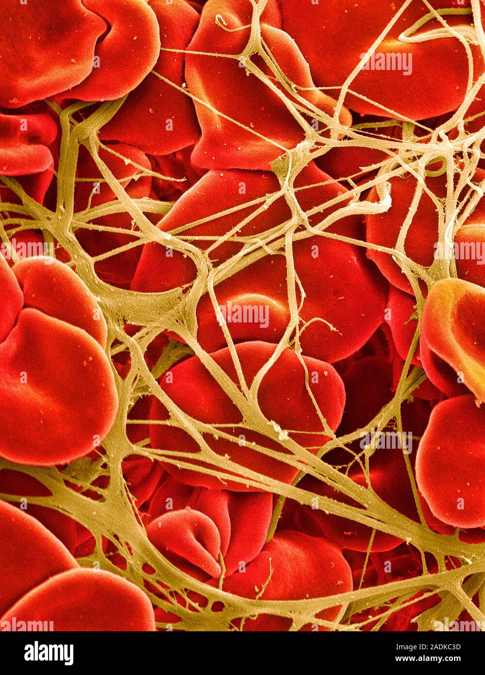 Blood clot. Coloured scanning electron micrograph (SEM) of red blood ...