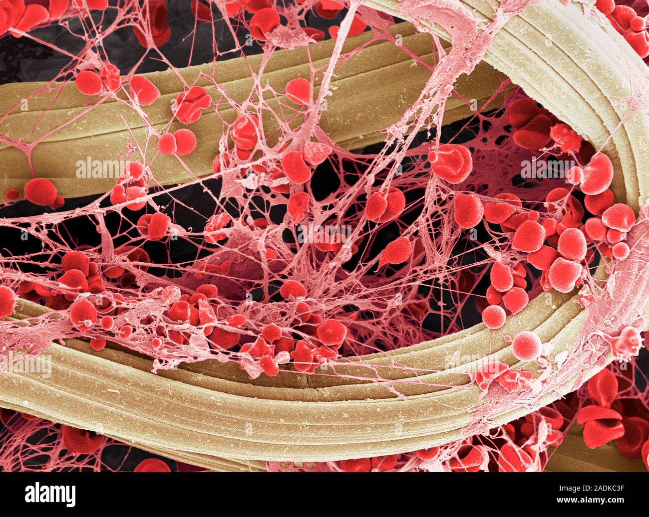Blood clot on plaster. Coloured scanning electron micrograph (SEM) of ...