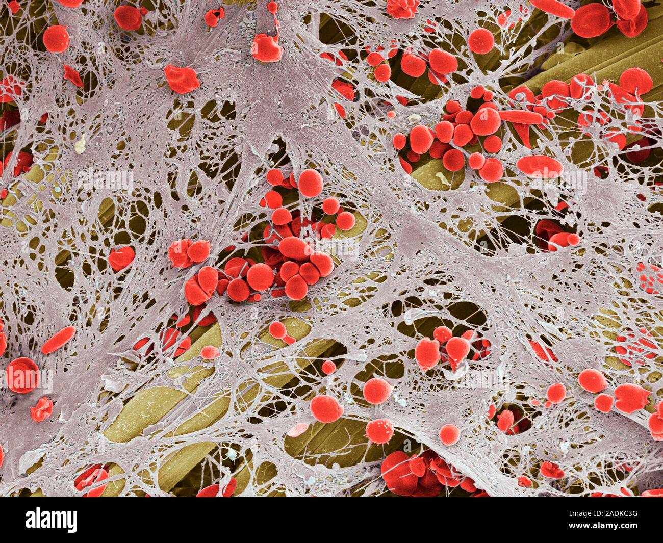 Blood clot on plaster. Coloured scanning electron micrograph (SEM) of ...