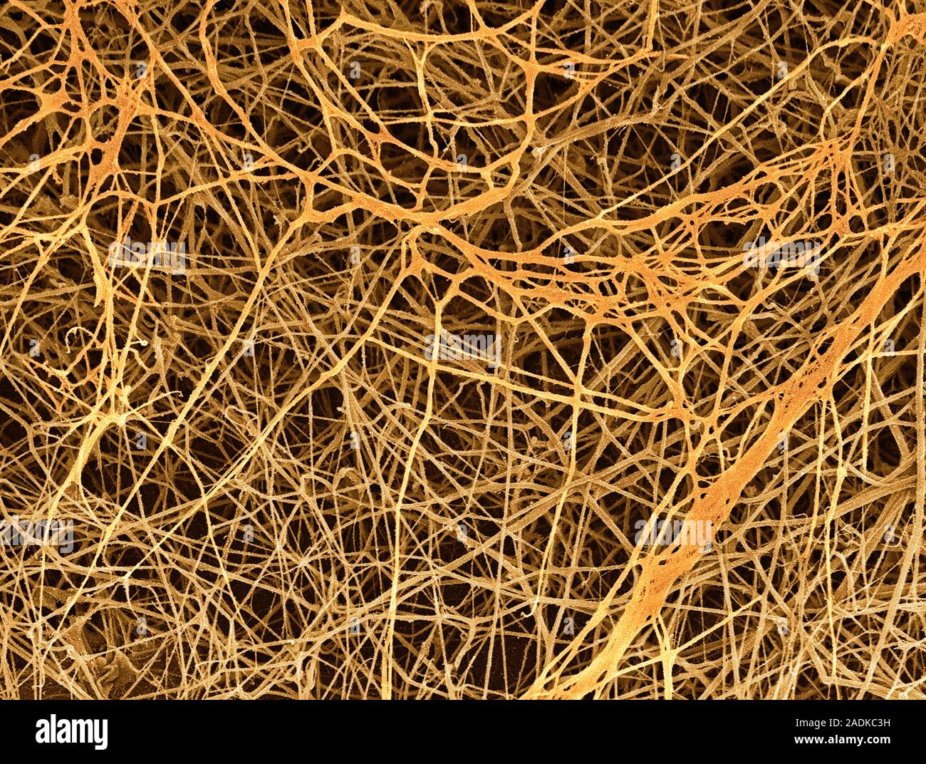 Fibrin mesh in a blood clot. Coloured scanning electron micrograph of ...