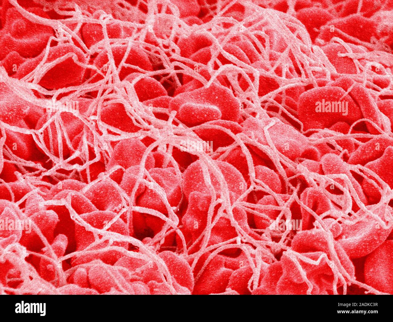 Blood clot. Coloured scanning electron micrograph (SEM) of a blood clot ...