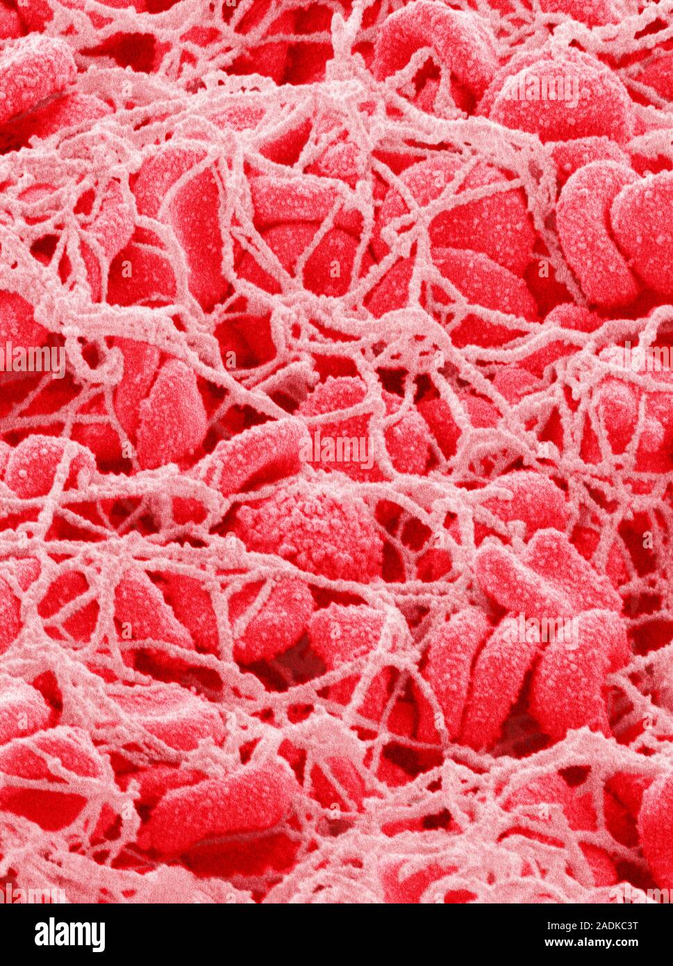 Blood clot. Coloured scanning electron micrograph (SEM) of a blood clot ...