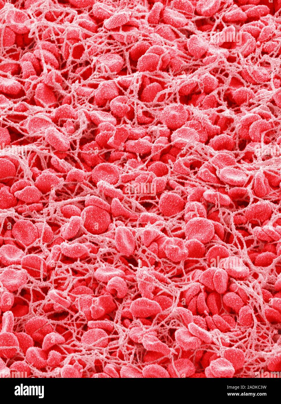 Blood clot. Coloured scanning electron micrograph (SEM) of a blood clot ...