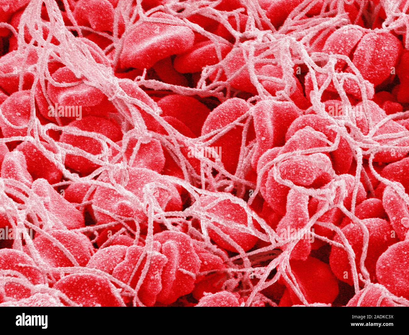 Blood clot. Coloured scanning electron micrograph (SEM) of a blood clot ...