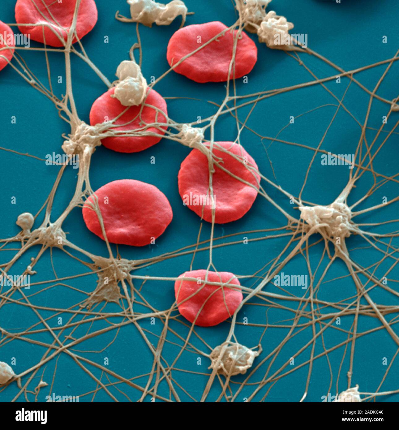 Blood clot. Coloured scanning electron micrograph (SEM) of a blood clot ...
