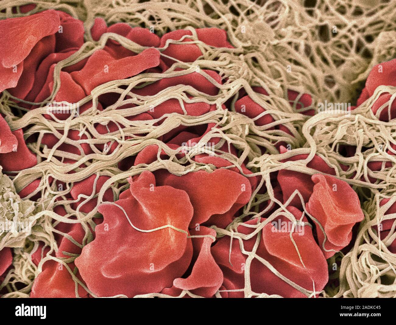 Blood clot. Coloured scanning electron micrograph (SEM) of a blood clot ...