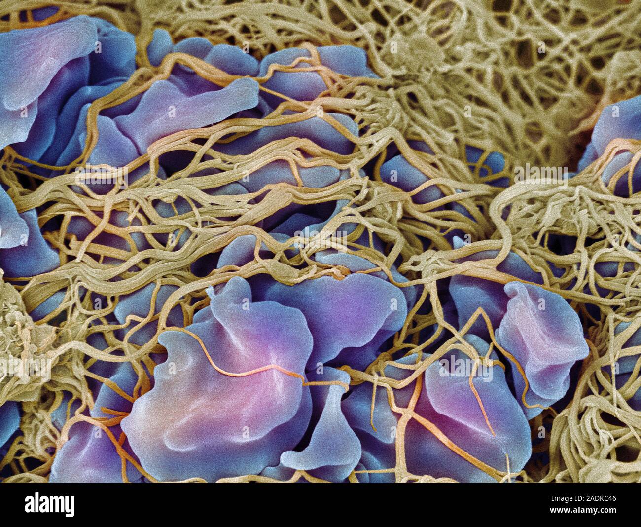Blood clot. Coloured scanning electron micrograph (SEM) of a blood clot ...