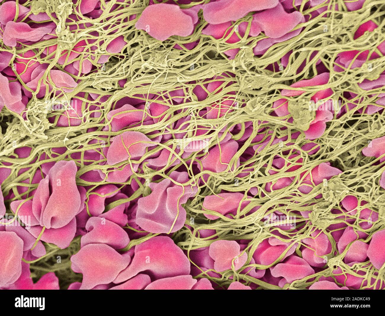 Blood clot. Coloured scanning electron micrograph (SEM) of a blood clot ...