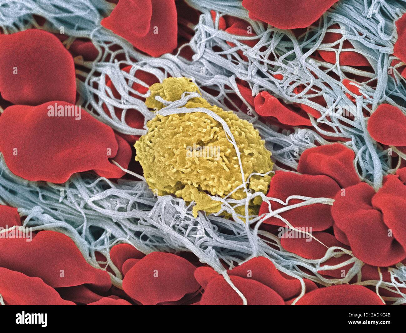 Blood clot. Coloured scanning electron micrograph (SEM) of a blood clot ...