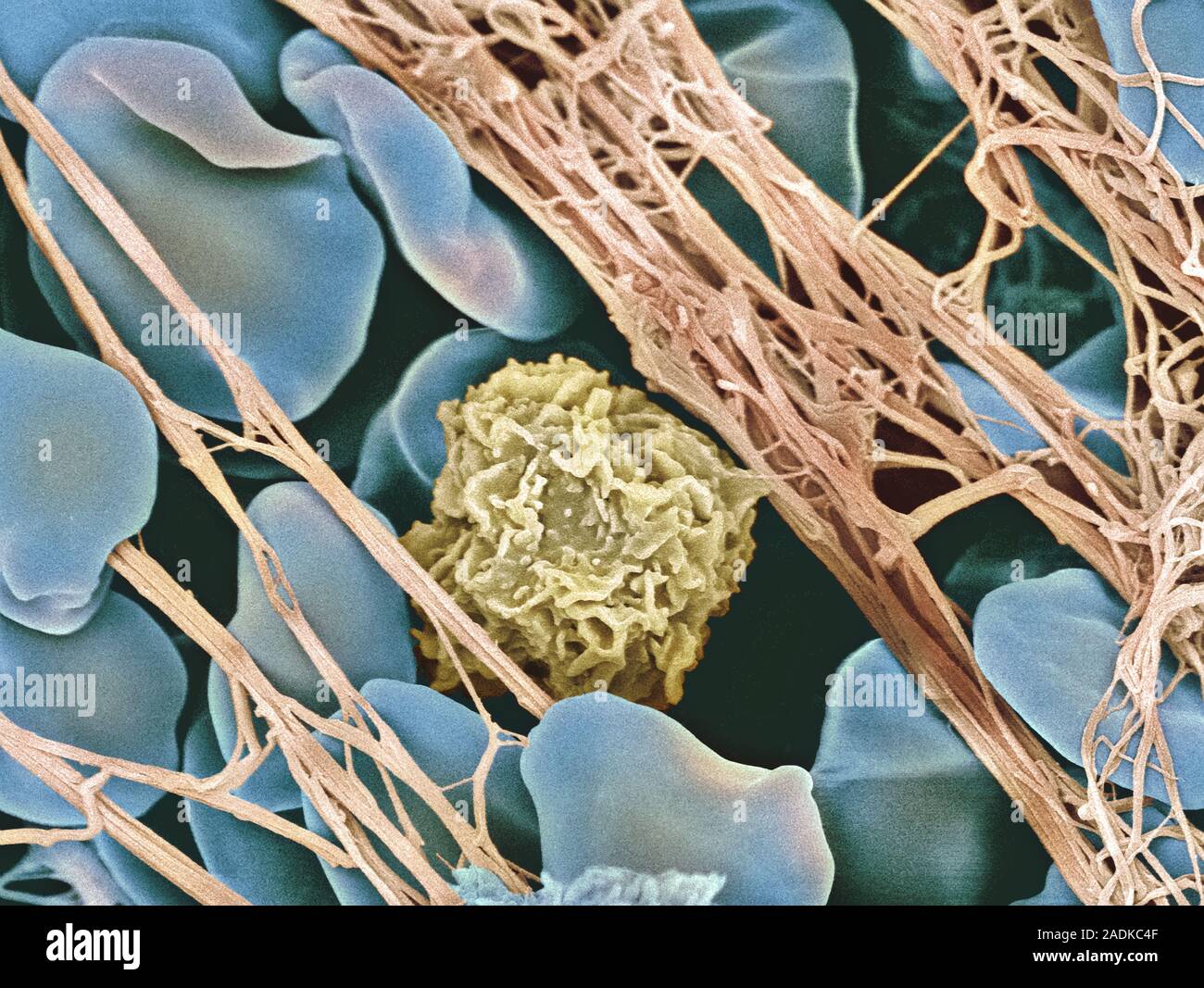 Blood clot. Coloured scanning electron micrograph (SEM) of a blood clot ...