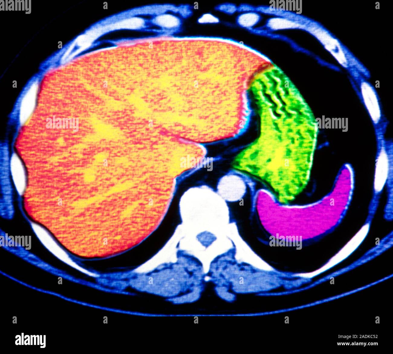 Human spleen. Coloured Computed Tomography (CT) scan of an axial section through the abdomen ...