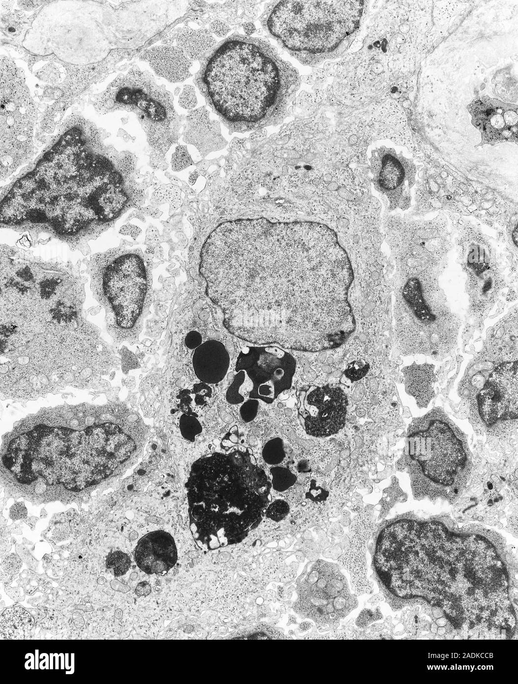 Transmission electron micrograph of a macrophage from a human tumour ...