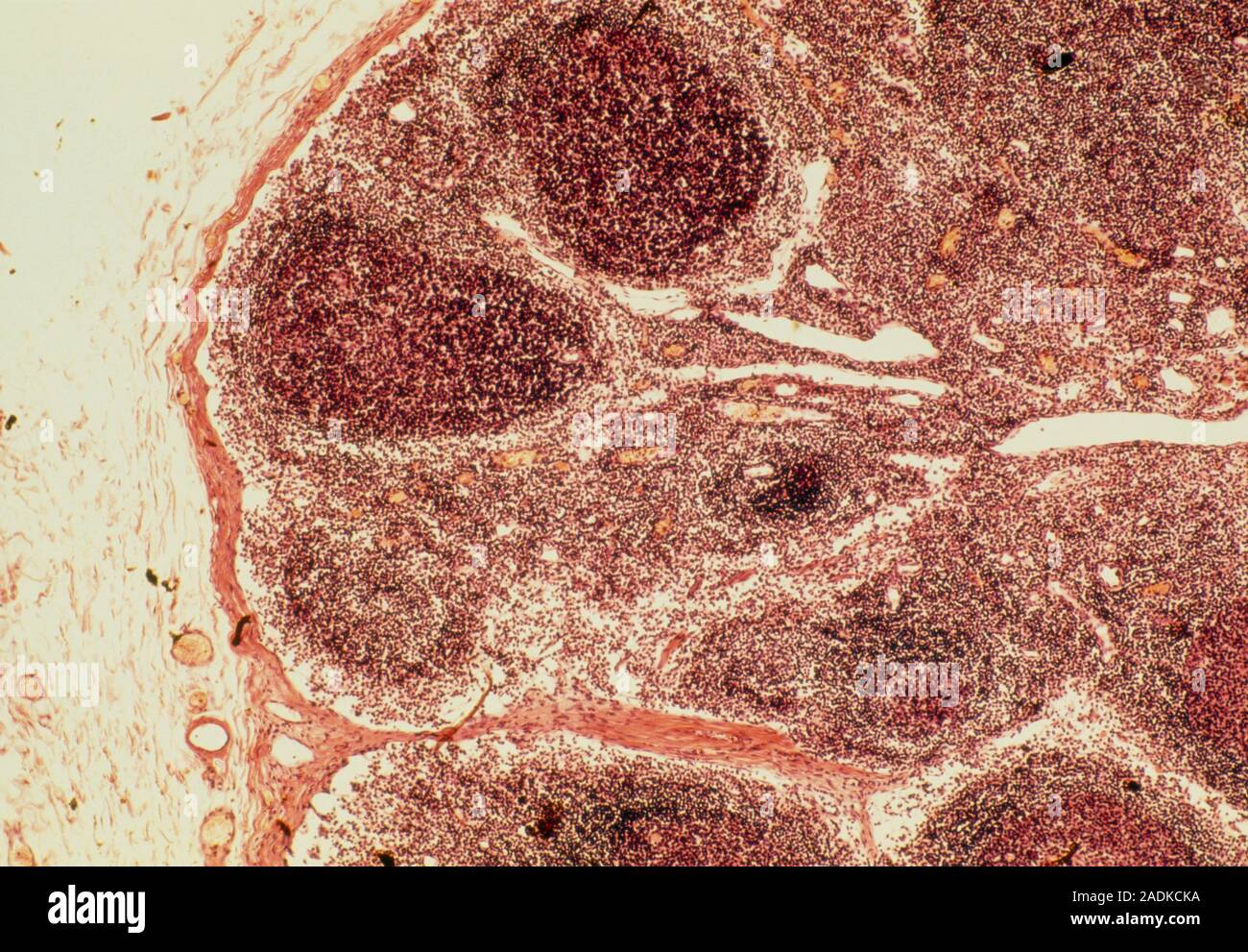 Lymph node. Light micrograph of a section through a healthy human lymph ...