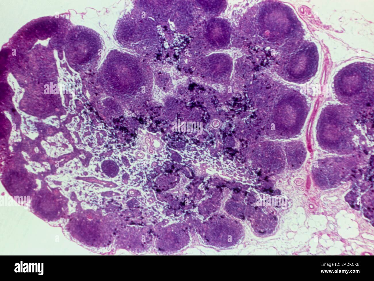 Lymph node. Light micrograph of a section through a lymph node, part of ...