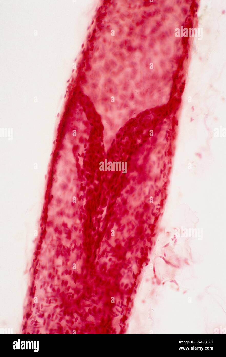Lymphatic vessel valve. Light micrograph of a vessel from the human ...