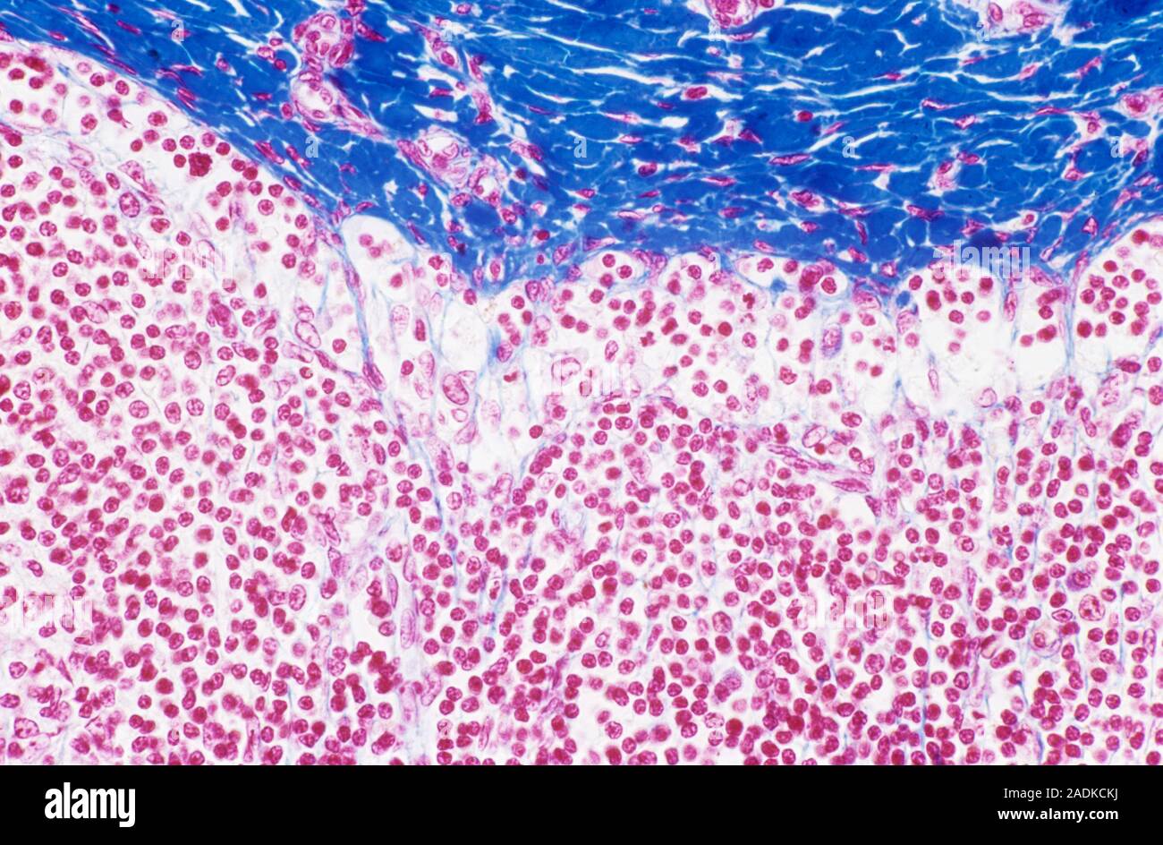 Lymph node sinus. Light micrograph of a section through a lymph node, a ...