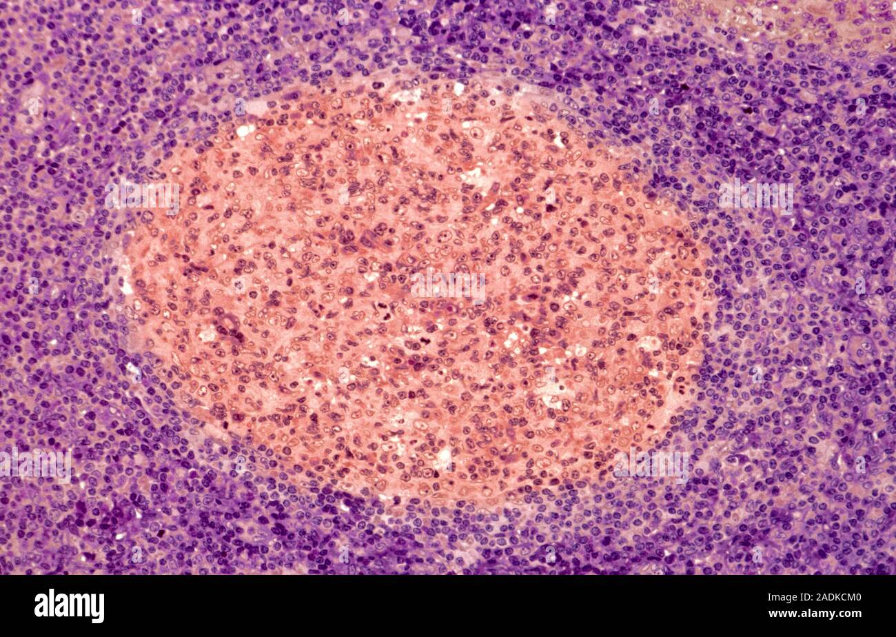 Lymph node. Coloured light micrograph of a section through a lymph node ...