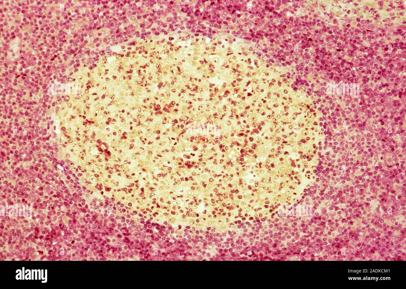 Lymph node. Coloured light micrograph of a section through a lymph node ...