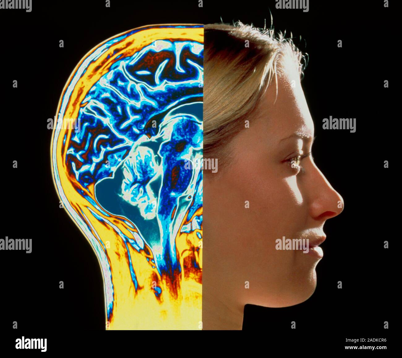 Face and brain scan. Coloured Magnetic Resonance Imaging (MRI) scan of ...