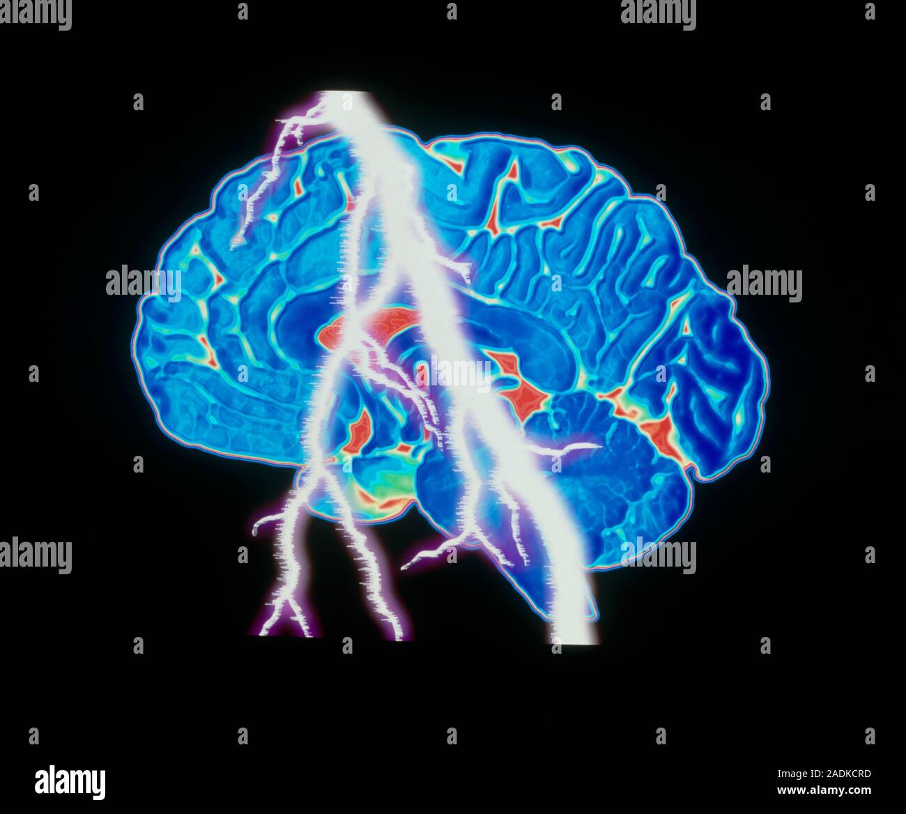 Headache or epilepsy. Abstract image of a Computed Tomography (CT) scan ...