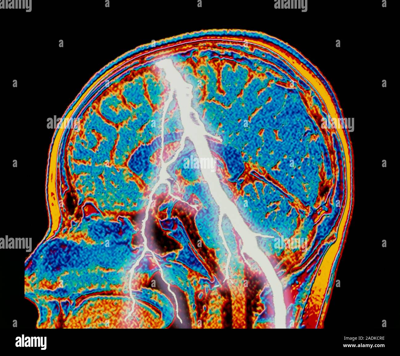 Headache or epilepsy. Abstract image of a Computed Tomography (CT) scan ...