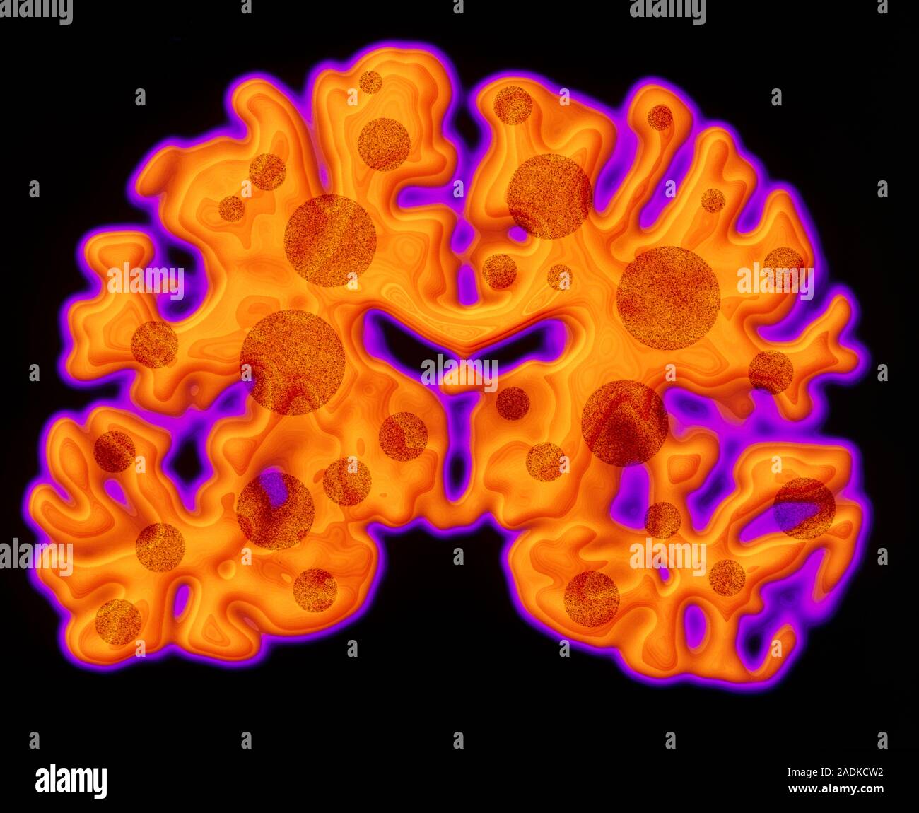 Brain damage. Conceptual computer illustration of brain damage depicted ...