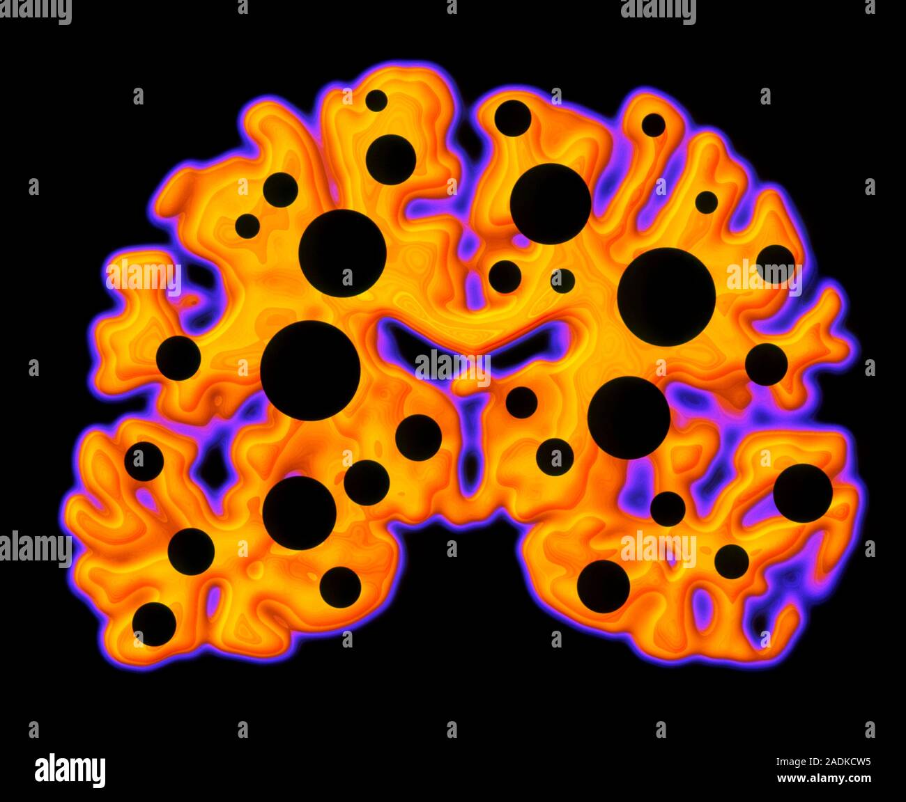 Brain damage. Conceptual computer illustration of brain damage depicted ...
