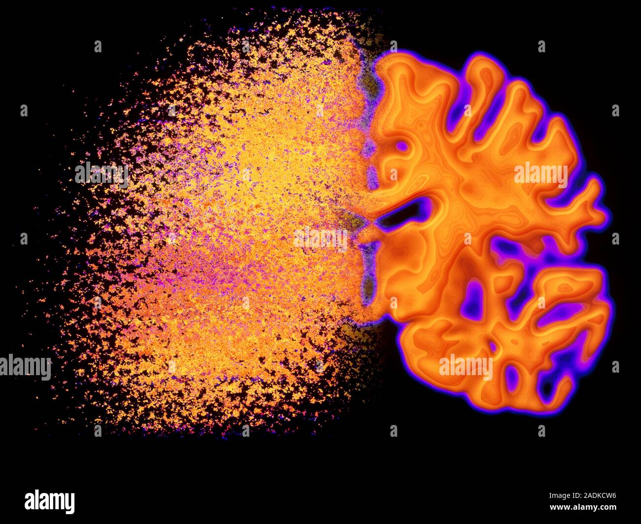 Brain disorder. Conceptual computer illustration of a brain disorder ...