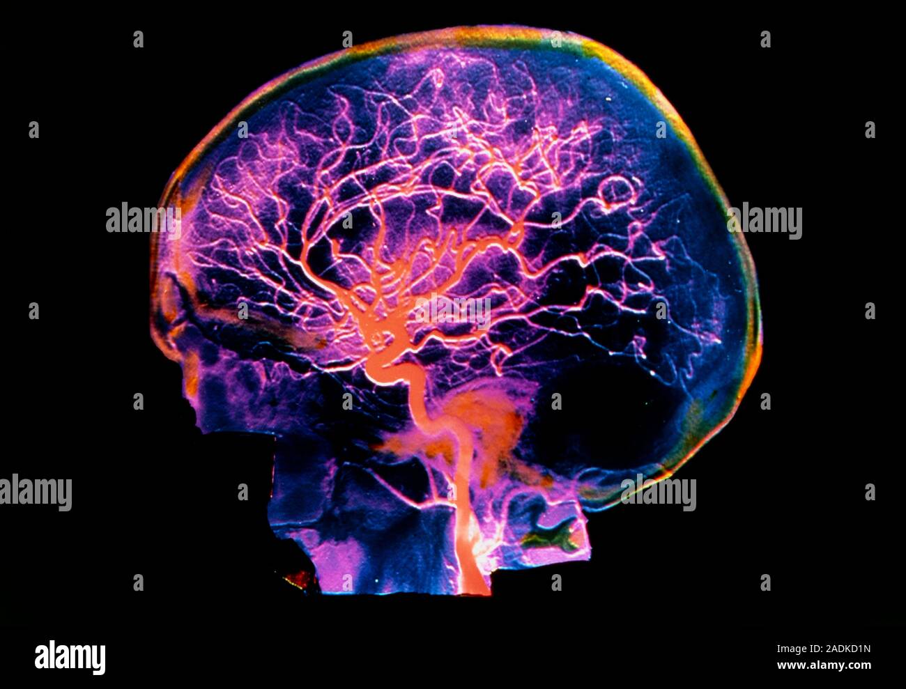 False-colour arteriograph (angiograph) of the human head, showing the ...