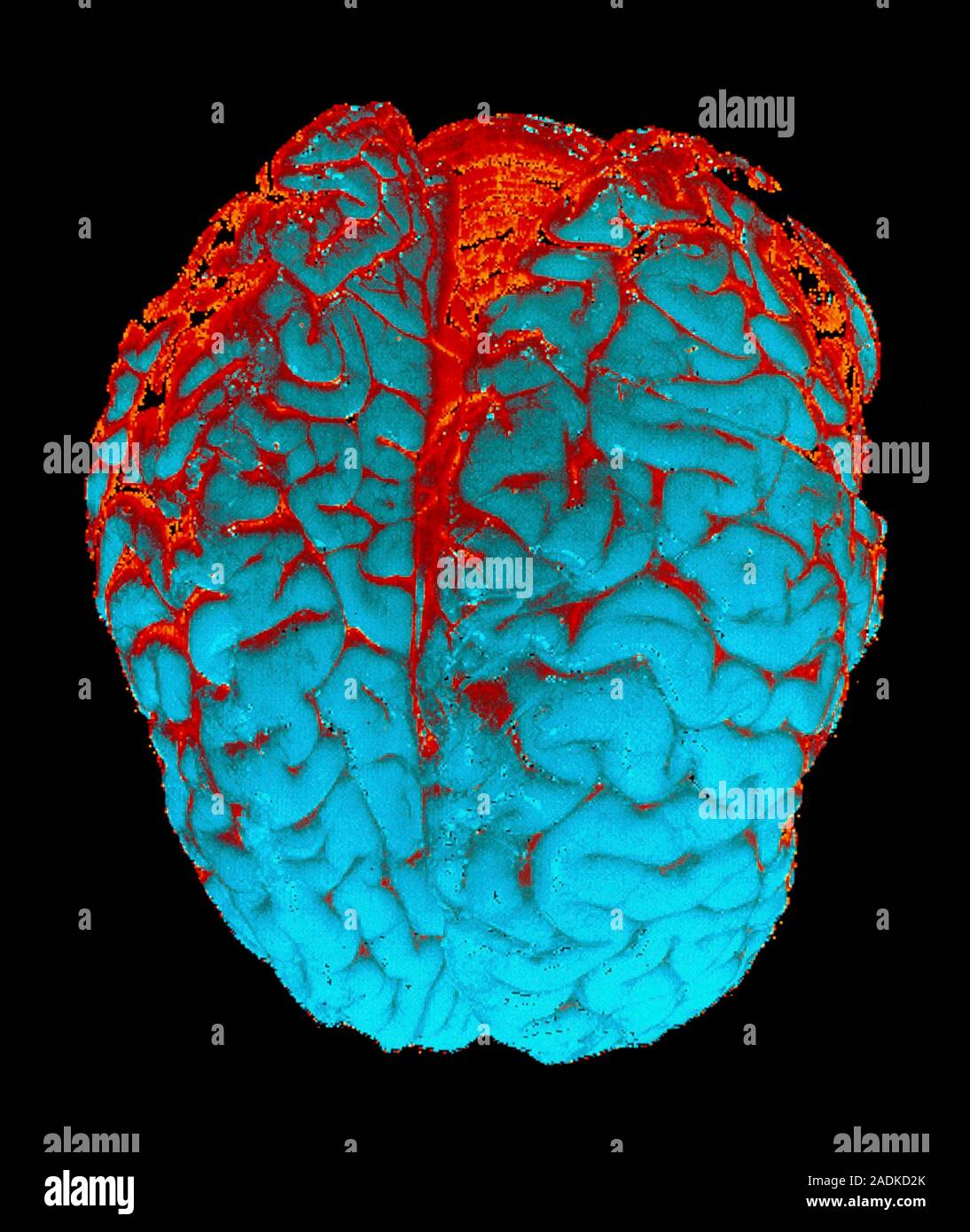 False-colour, digitized photograph of a normal human brain, seen from ...