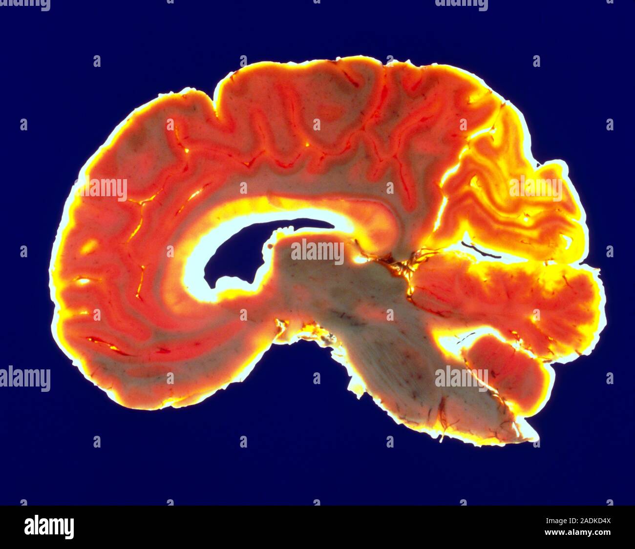 Human brain. Slice through a healthy brain, sectioned sagittally in the ...