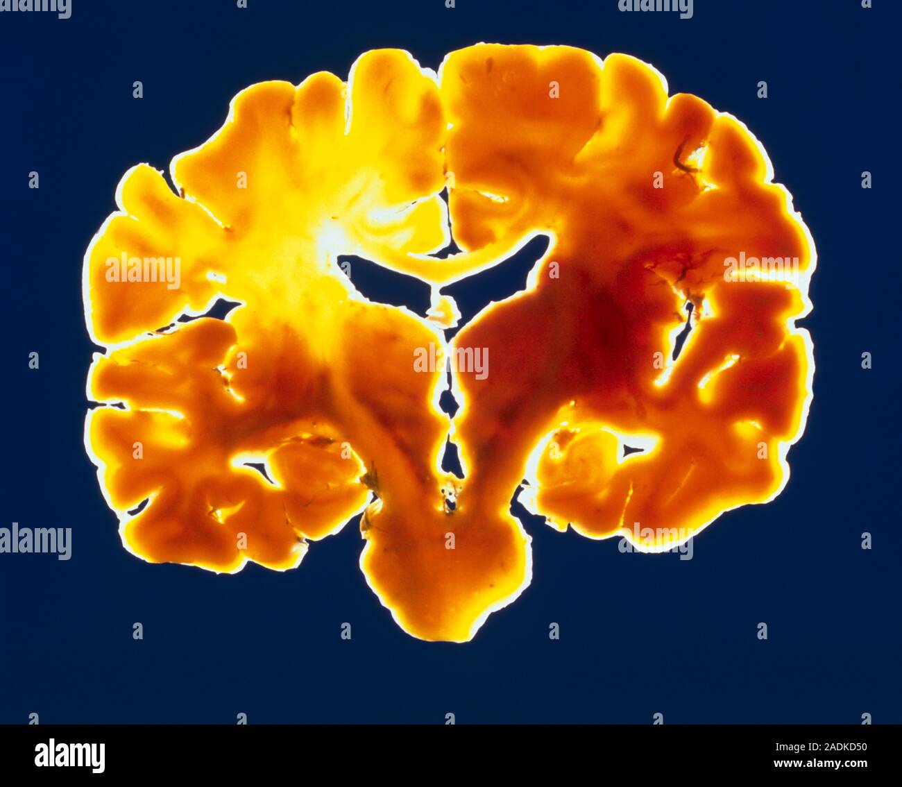 Human brain. Vertical slice through a healthy brain, sectioned ...