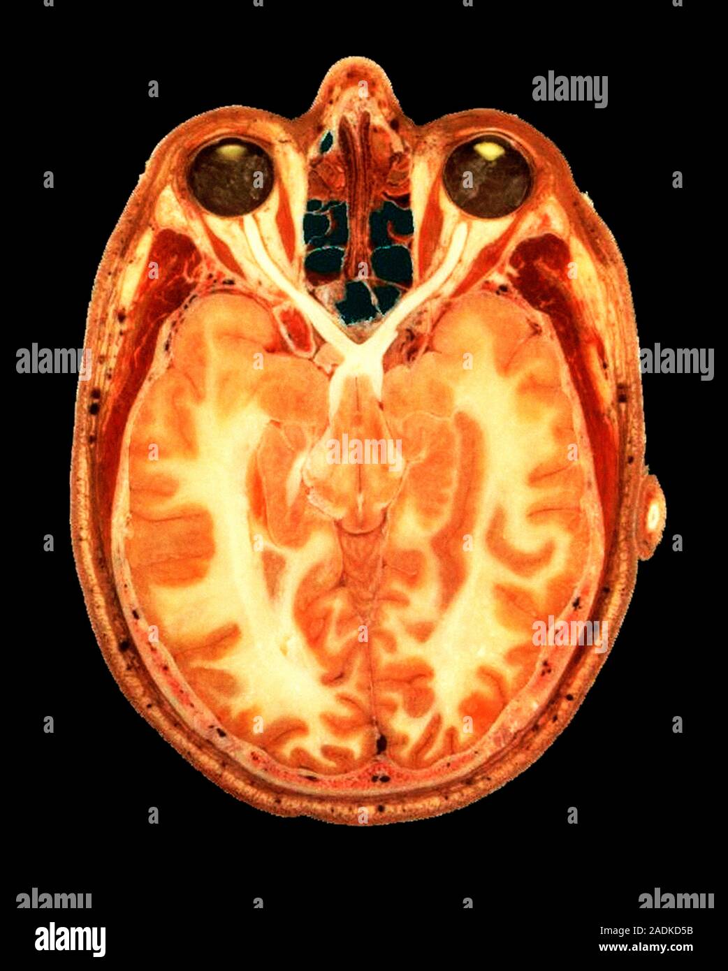 Healthy Brain Slice Brain Healthy Meal: Broccoli And Sun Dried Tomato
