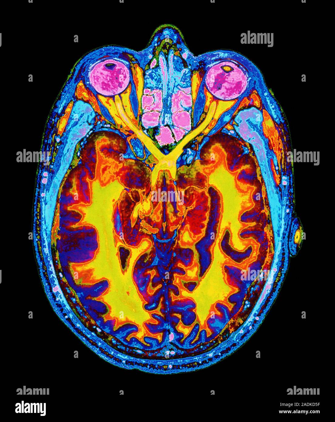 Section through a human head. Computer coloured axial slice through the ...