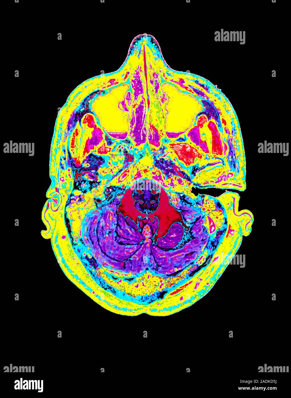 Section through a human head. Computer coloured axial (transverse ...
