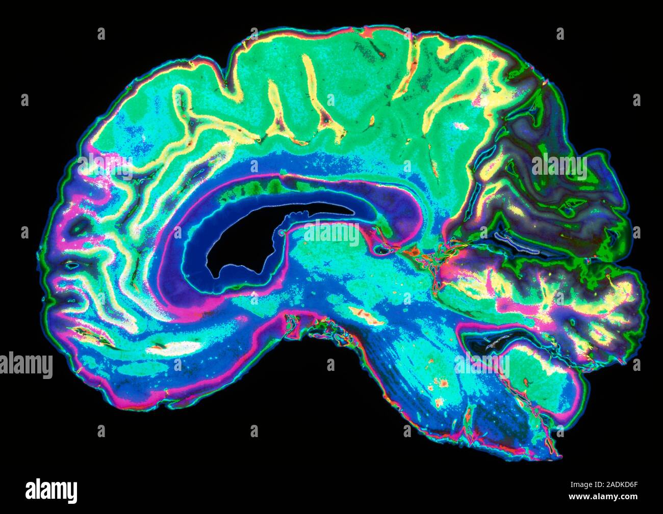 Healthy brain. Coloured sagittal slice through a healthy human brain ...