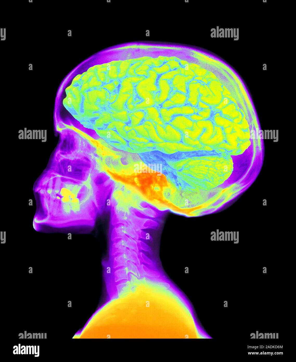 Healthy brain in skull. Coloured computer-enhanced X-ray of the human ...