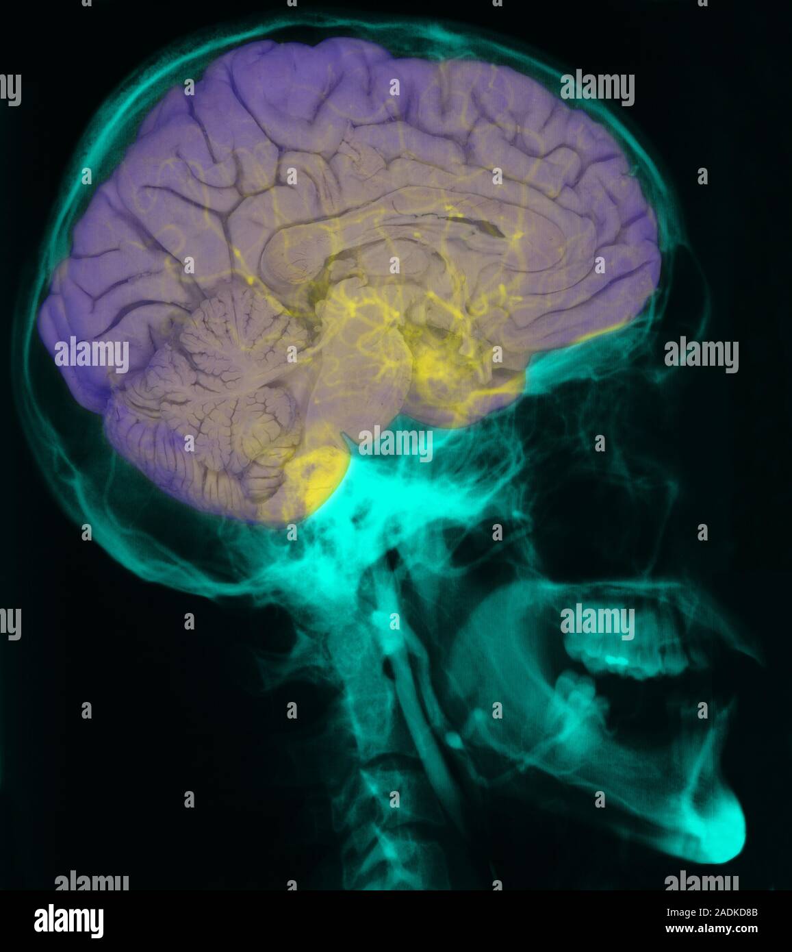 Brain on skull X-ray. Coloured composite image of a sectioned brain ...