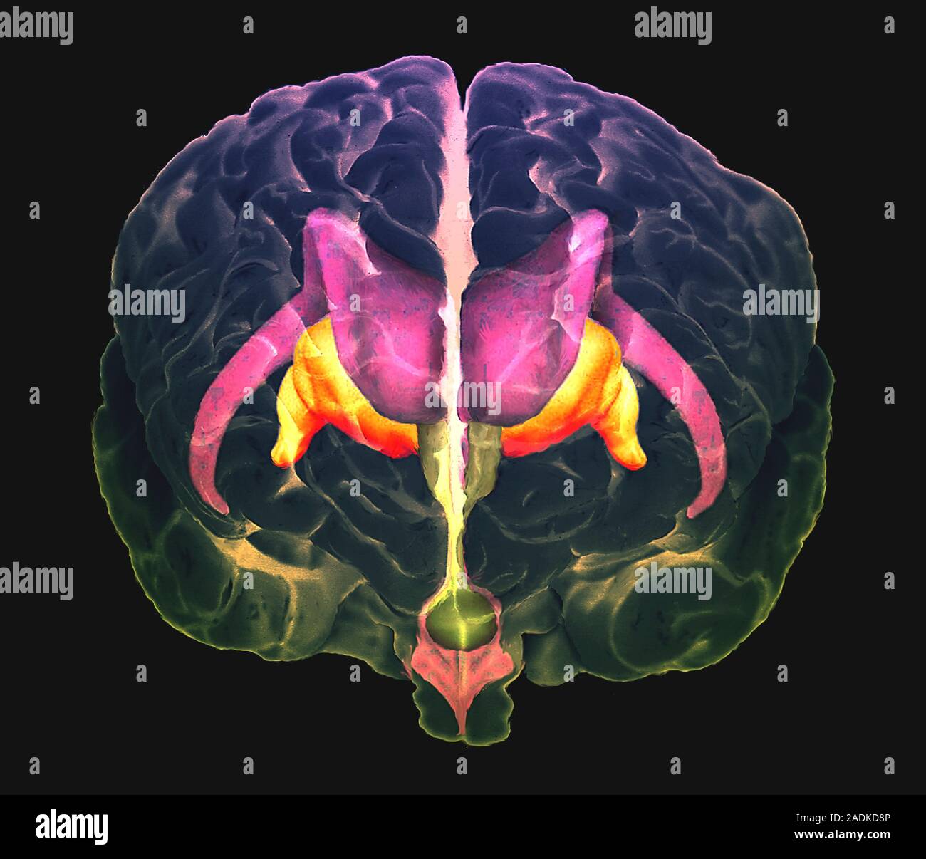 Brain. Coloured composite 3-D magnetic resonance imaging (MRI) and computed tomography (CT) scan ...