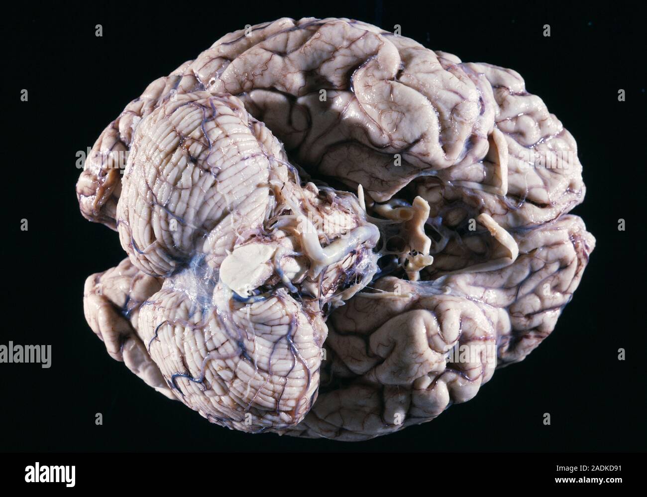 Brain. Gross clinical specimen of a human brain seen from below, with ...