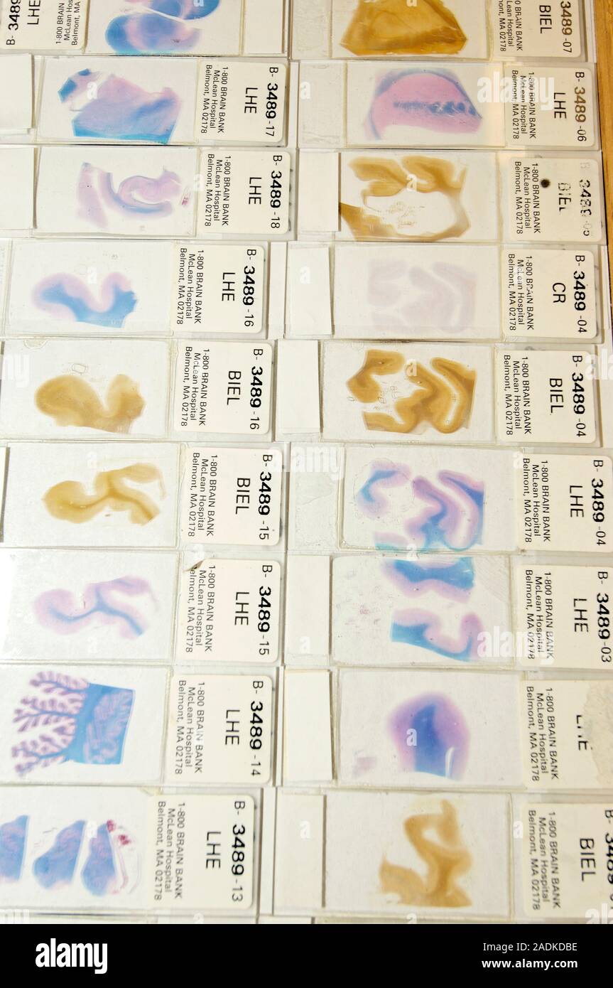Human brain microscope slides. Microscope slides of stained sections of ...