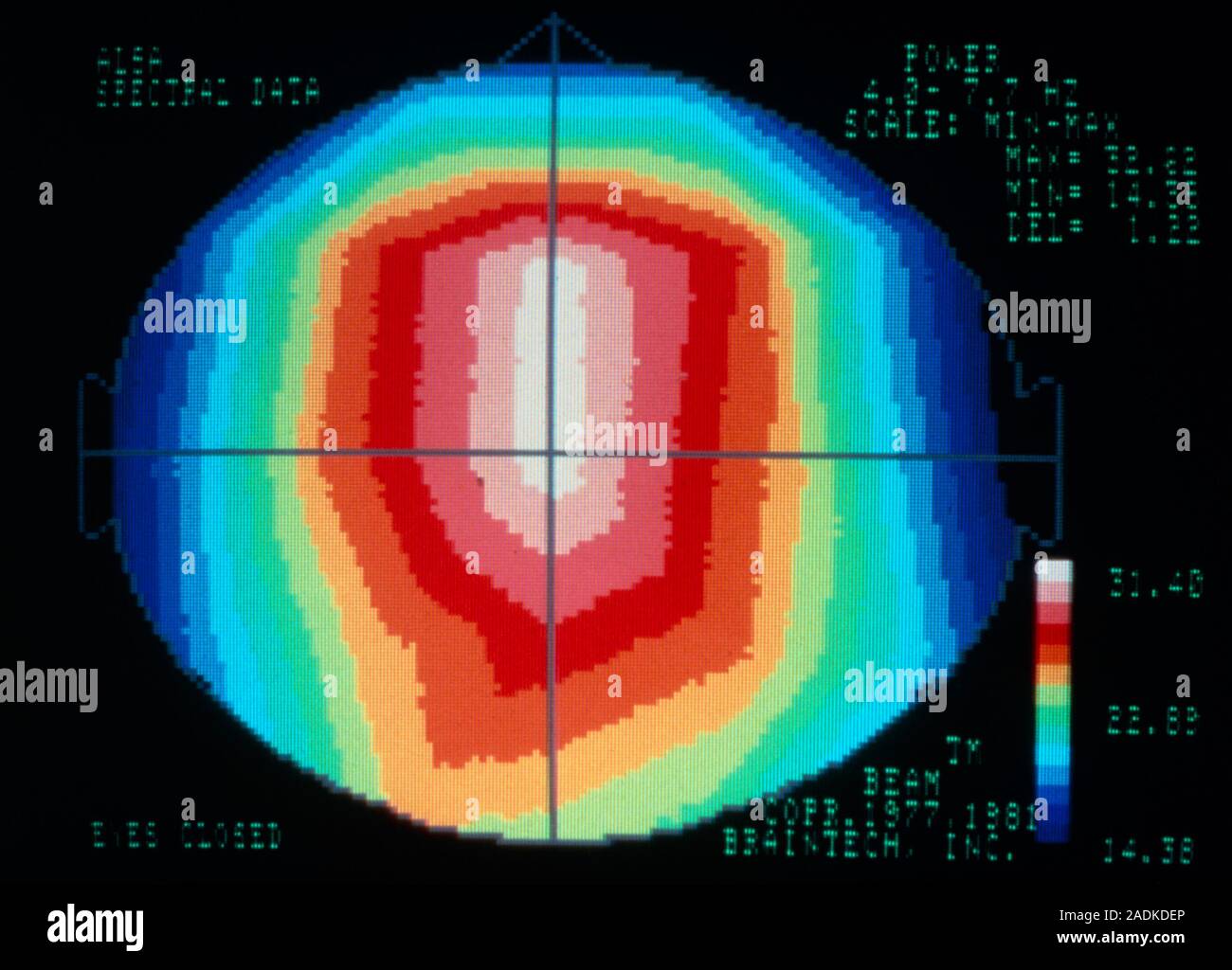 An image of the brain made using brain electrical activity mapping (BEAM), a development of ...