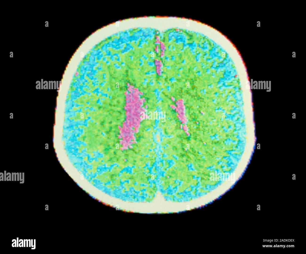 CAT scan image (computed axial tomography) of the brain of a new-born ...