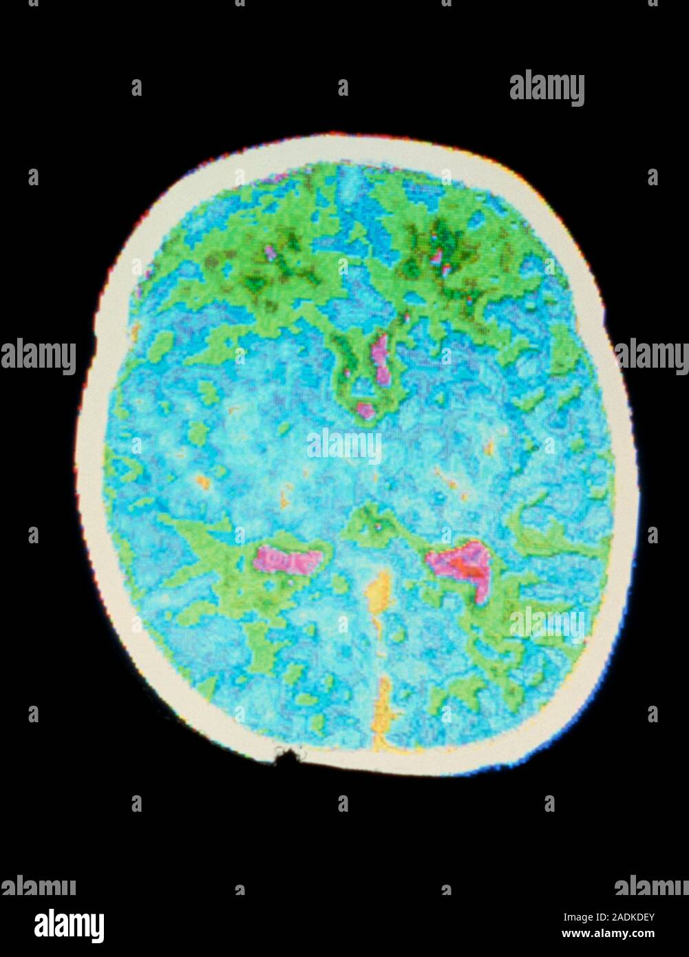 CAT scan image (computed axial tomography) of the brain of a 2 years ...