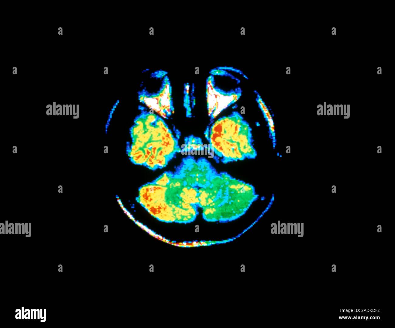 False colour Nuclear Magnetic Resonance (NMR) image of an adult human ...