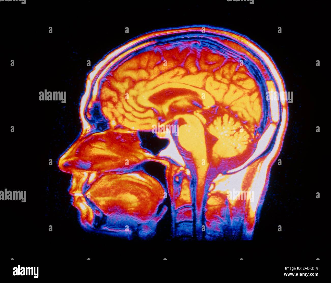 False-colour nuclear magnetic resonance (NMR) image of a mid-sagittal ...