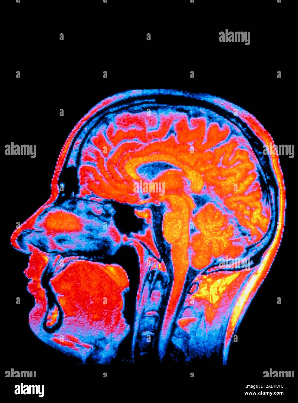 False-colour nuclear magnetic resonance (NMR) image of a mid-sagittal ...