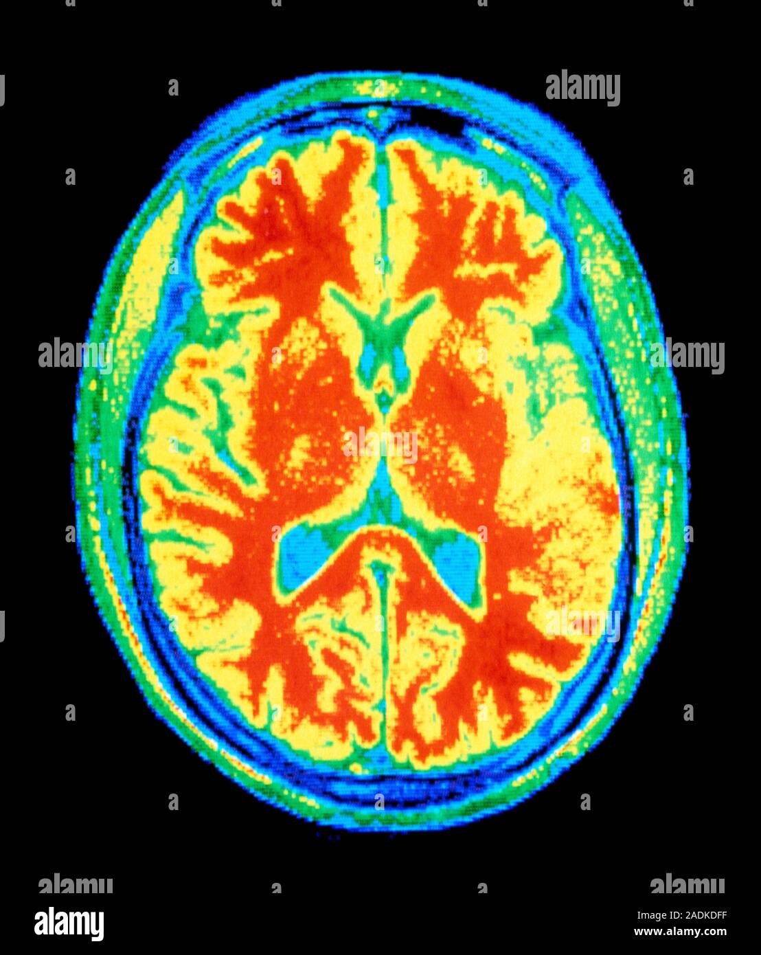 False-colour nuclear magnetic resonance (NMR) image of an axial section ...
