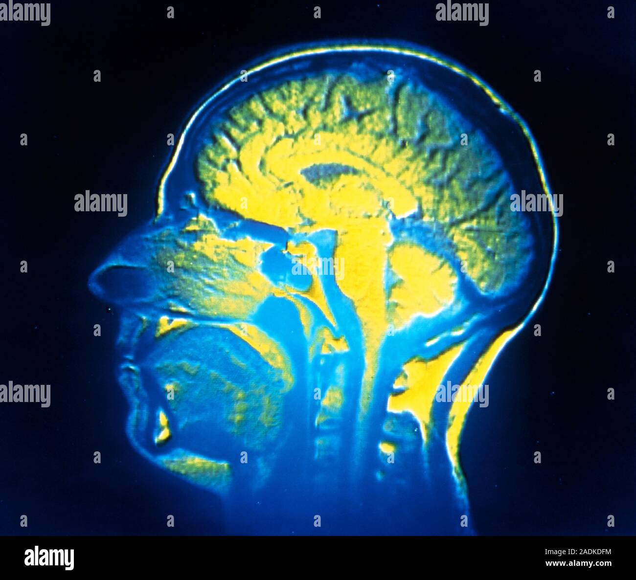 Nuclear Magnetic Resonance (NMR) image of a human head, showing details ...