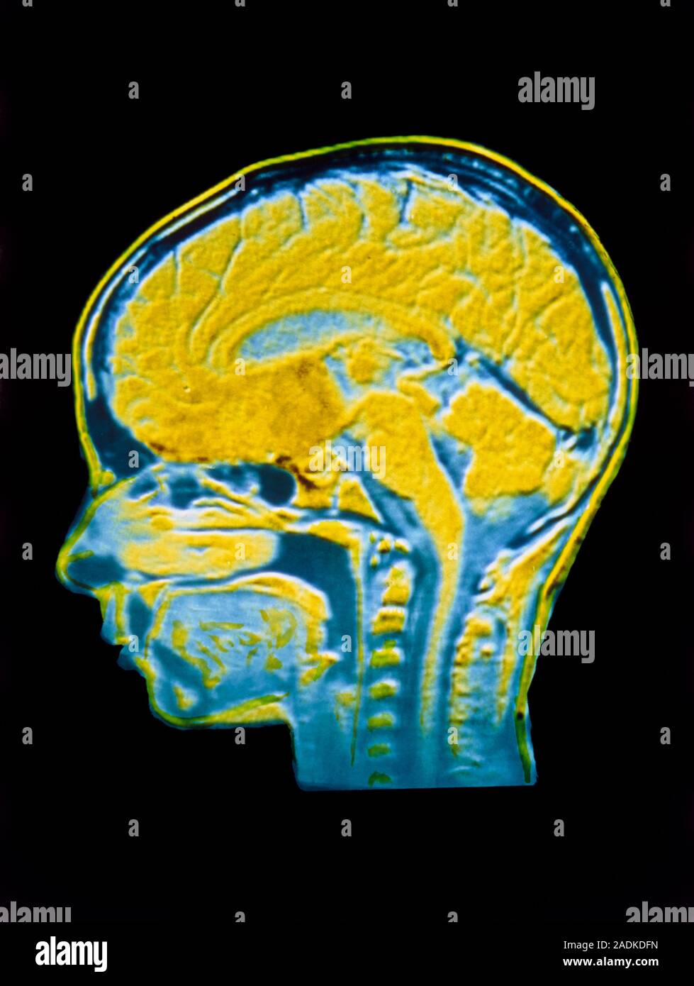 False-colour nuclear magnetic resonance (NMR) image of a sagittal ...